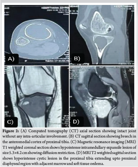 A Rare Case Report of Advanced Surgical Management of Proximal Tibia ...