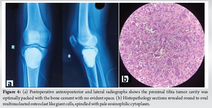 A Rare Case Report of Advanced Surgical Management of Proximal Tibia ...