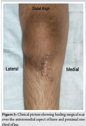A Rare Case Report of Advanced Surgical Management of Proximal Tibia ...