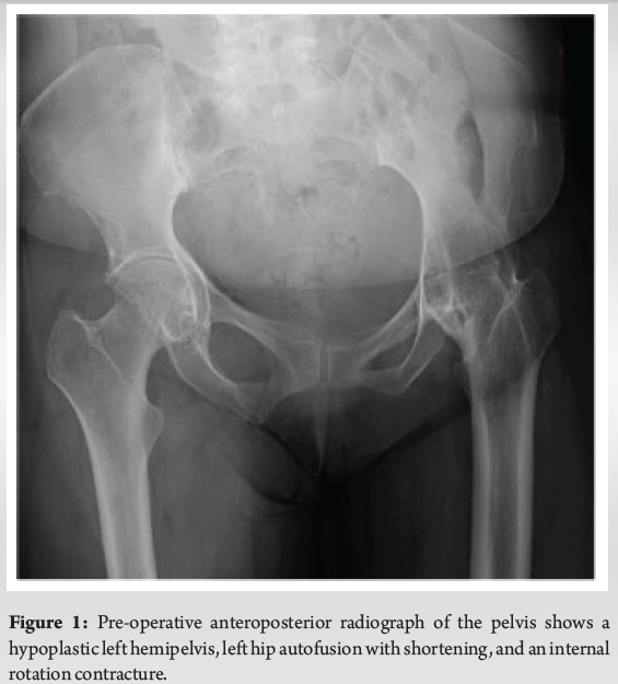 Hip Fusion Takedown with Dislocation and Cup Dislodgement Requiring ...