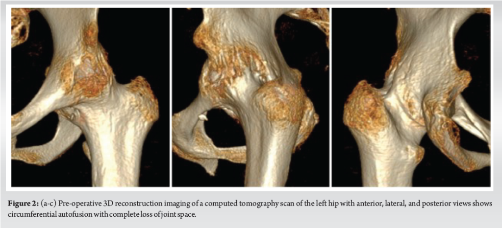 Hip Fusion Takedown with Dislocation and Cup Dislodgement Requiring ...