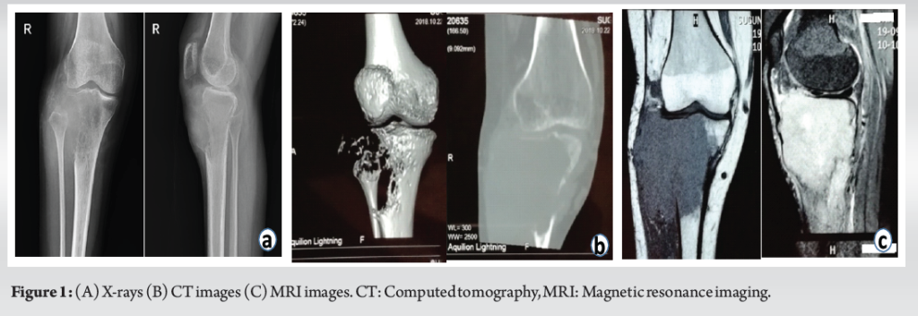 Aggressive Giant Cell Tumor of Proximal Tibia Treated with Resection ...