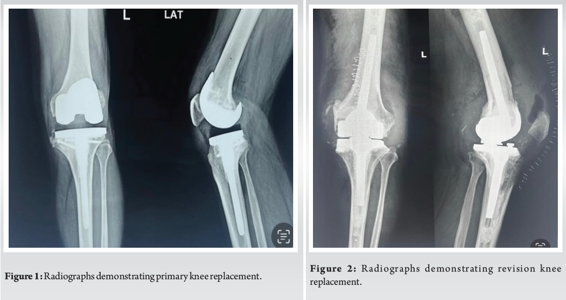 A Rare Case of Posterior Dislocation of Hinge Knee Prosthesis due to ...