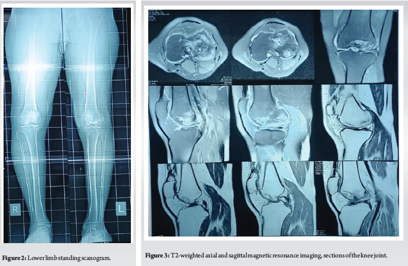 A Rare Case of Lateral Femoral Condyle Osteonecrosis of Knee in a Young ...