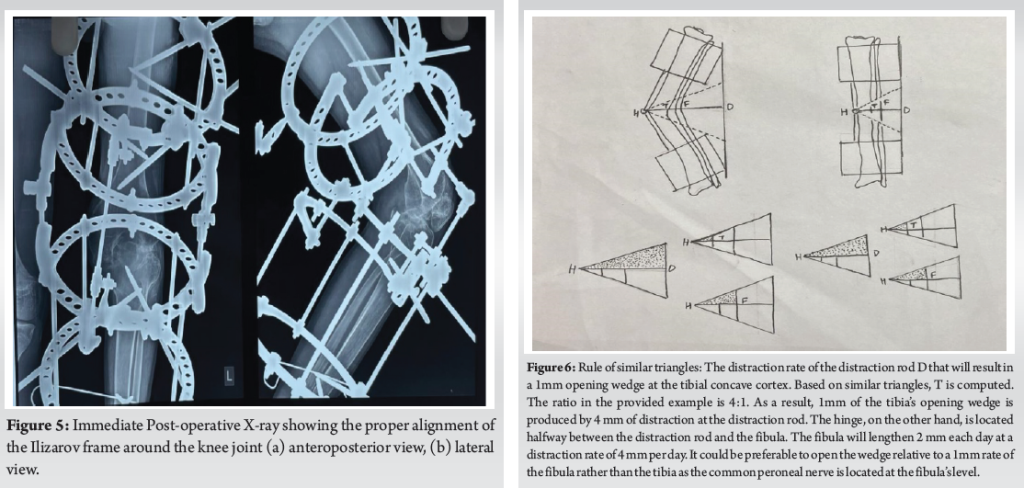 A Case of Complex Deformity of Knee Corrected by Ilizarov Fixation in a ...