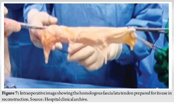 Reconstruction of the Proximal Portion of the Brachial Triceps Muscle ...