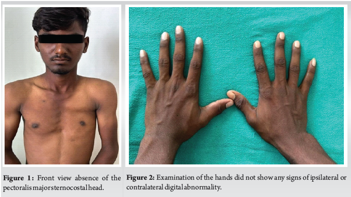 An Unusual Case of Left-Sided Poland Syndrome Presenting with ...