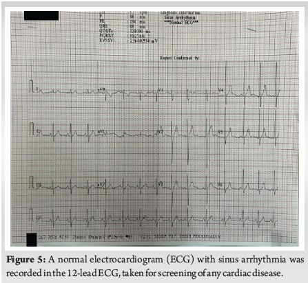 An Unusual Case of Left-Sided Poland Syndrome Presenting with ...