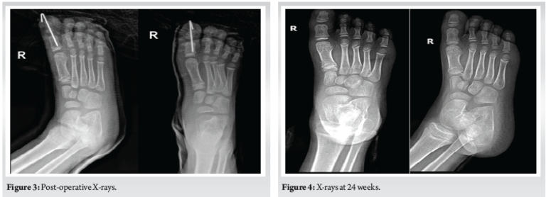 Open Dislocation of Hallux Interphalangeal Joint in a Child: A Rare ...