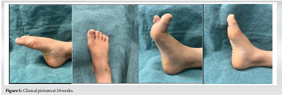 Open Dislocation of Hallux Interphalangeal Joint in a Child: A Rare ...