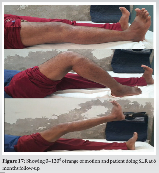 A Rare Case Report: Managing PCL Avulsion Fracture with a Fracture of ...
