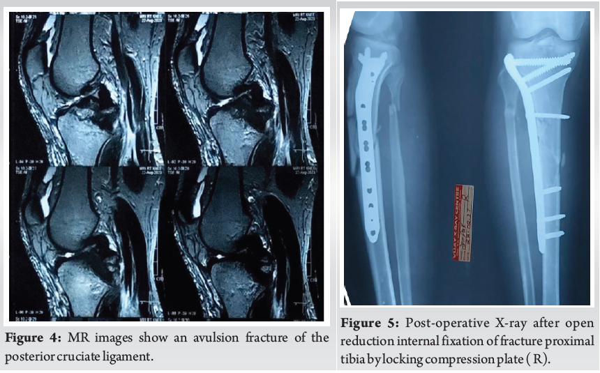 A Rare Case Report: Managing PCL Avulsion Fracture with a Fracture of ...