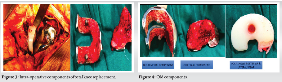 A Case Report on the Management of Peri-Prosthetic Fracture in a Post ...