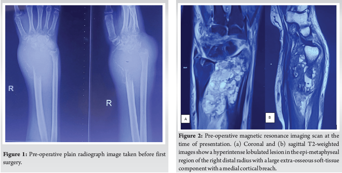 Revolutionizing Limb Preservation: A Case Report on Recurrent Fungating ...