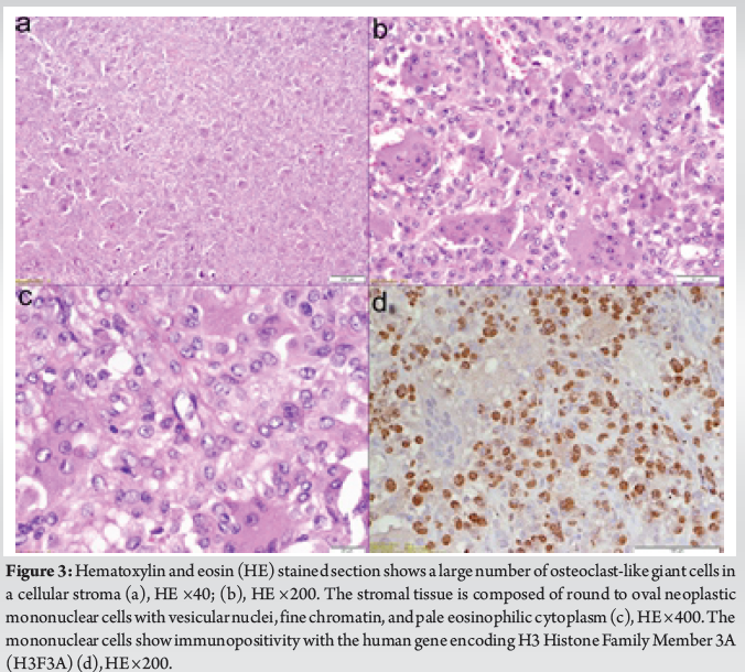 Revolutionizing Limb Preservation: A Case Report on Recurrent Fungating ...