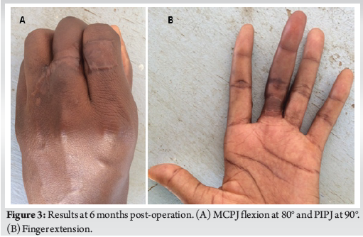 Cross-finger Flap on Electrical Ring Burn Injury: A Case Report ...