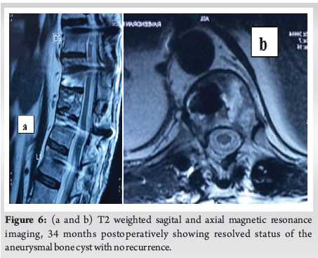 Aneurysmal Bone Cyst of Thoracic Spine in an Elderly Treated by Two ...