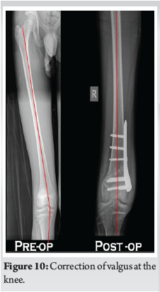 Combined Sulcus Deepening Trochleoplasty, Varus Distal Femoral ...