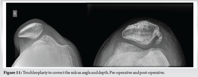 Combined Sulcus Deepening Trochleoplasty, Varus Distal Femoral ...