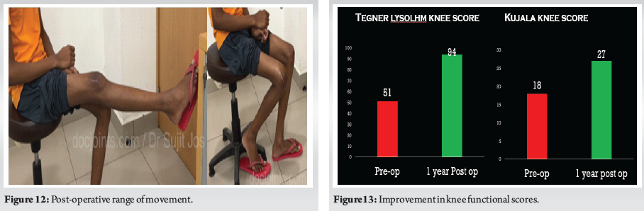 Combined Sulcus Deepening Trochleoplasty, Varus Distal Femoral ...