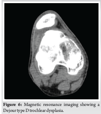 Combined Sulcus Deepening Trochleoplasty, Varus Distal Femoral ...