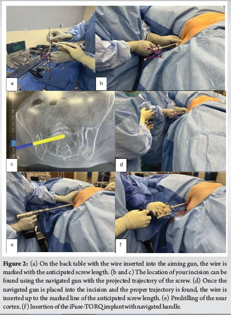 Stealth Navigation with iFuse-TORQ Implant for Sacroiliac Joint Fusion ...