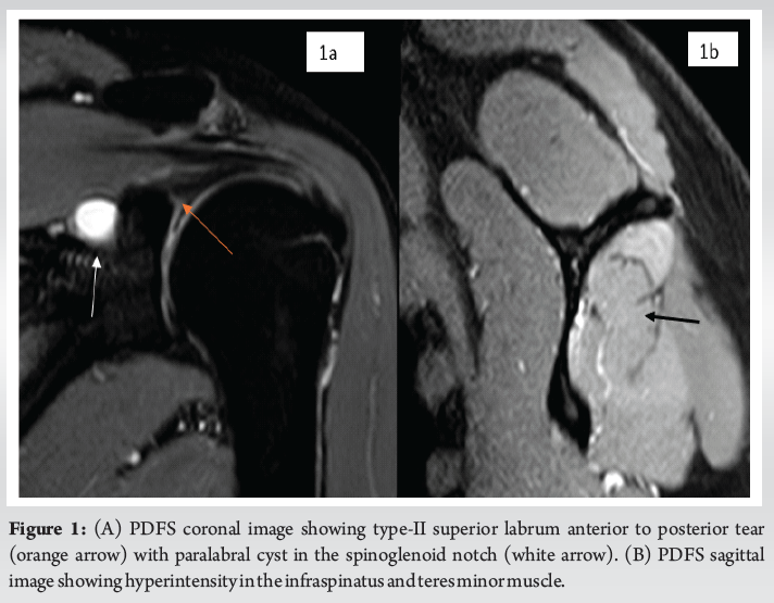 Glenoid Paralabral Cysts Causing Shoulder Pain and Isolated ...