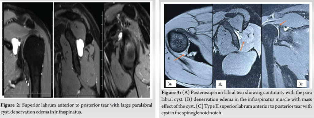 Glenoid Paralabral Cysts Causing Shoulder Pain and Isolated ...