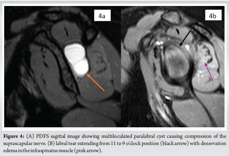 Glenoid Paralabral Cysts Causing Shoulder Pain and Isolated ...
