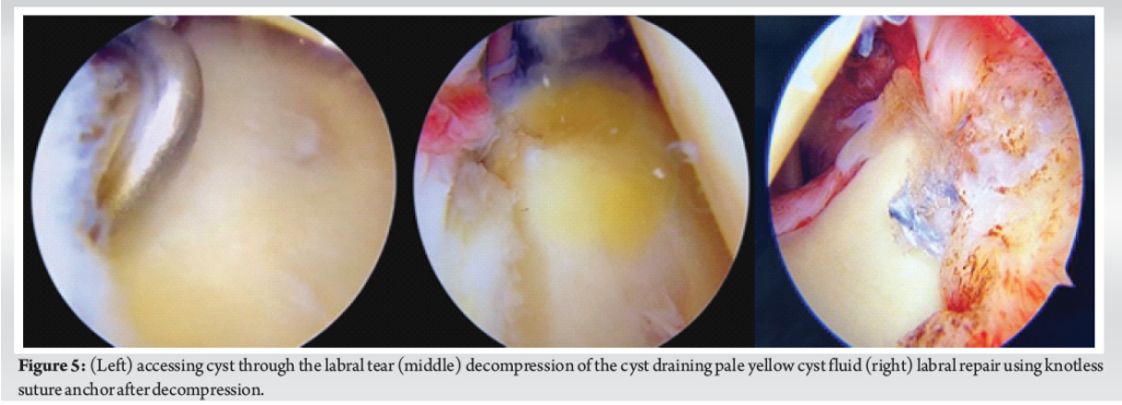 Glenoid Paralabral Cysts Causing Shoulder Pain and Isolated ...