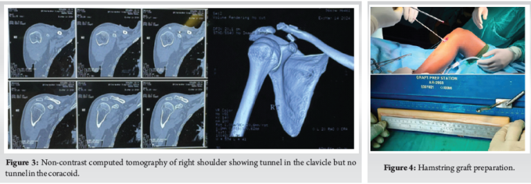 Failed Loop Endobutton Acromioclavicular Joint Reconstruction Treated ...