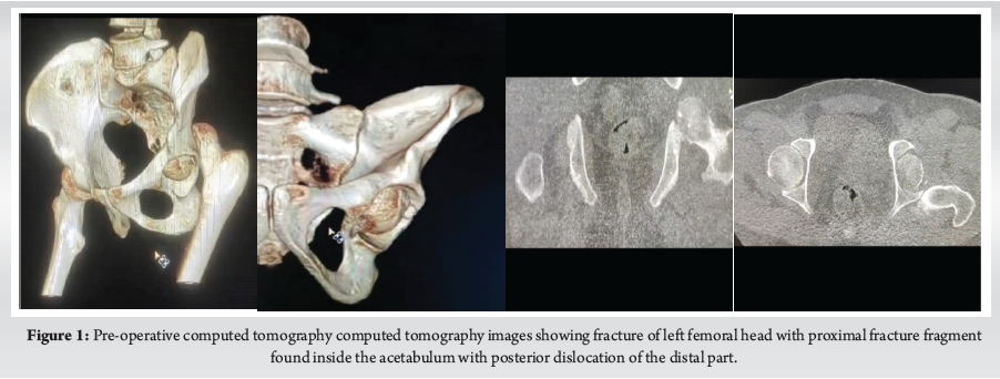 Extraarticular Interfragmentary Fixation of an Irreducible Pipkin Type ...