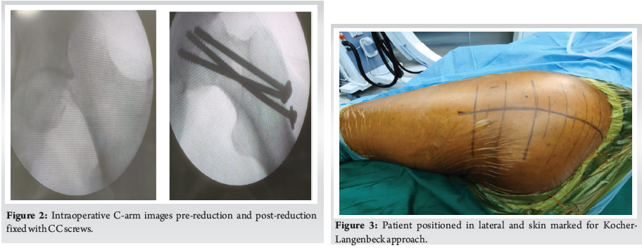 Extraarticular Interfragmentary Fixation of an Irreducible Pipkin Type ...