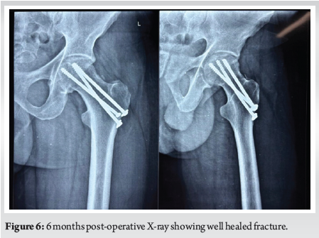 Extraarticular Interfragmentary Fixation of an Irreducible Pipkin Type ...