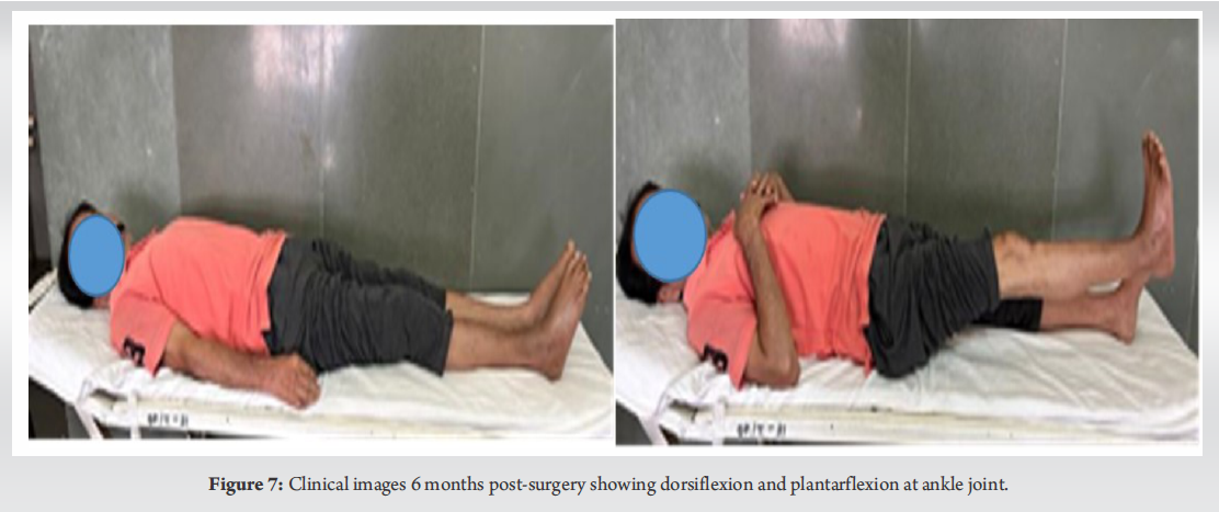 Surgical Management Protocol of Hawkins Type 3 Comminuted Fracture Neck ...