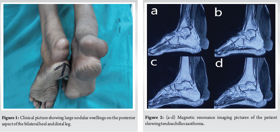 Massive Tendo Achilles Xanthoma Treated with en bloc Excision and ...