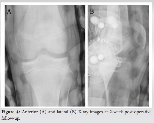 Tibial Eminence Fracture and Pediatric ACL Avulsion Diagnosis and ...