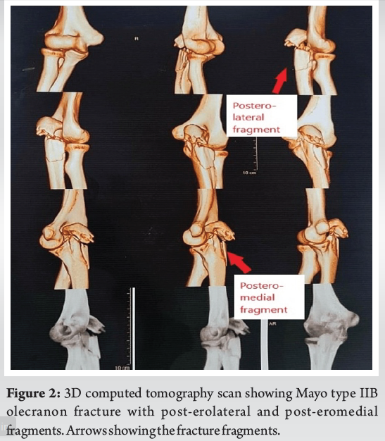 Fragment-specific Plate Fixation in a Case of Mayo Type IIB Olecranon ...