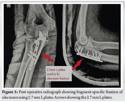 Fragment-specific Plate Fixation in a Case of Mayo Type IIB Olecranon ...