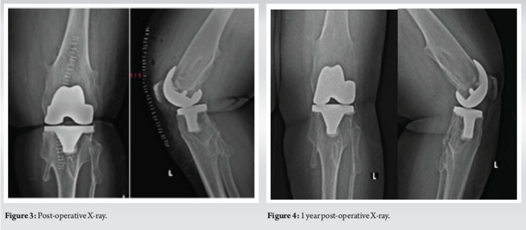 Total Knee Replacement for Varus Deformity in Osteoarthritis of Knee ...