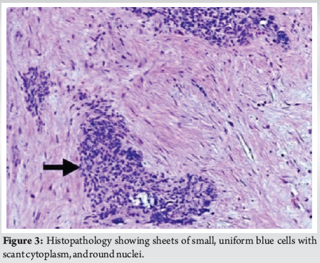 Unveiling the Uncommon: Ewing Sarcoma Cranium – A Rare Clinical ...