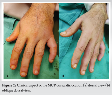 Management of a Rare Case of Complex and Irreducible Dislocation of the ...