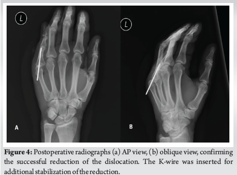 Management of a Rare Case of Complex and Irreducible Dislocation of the ...