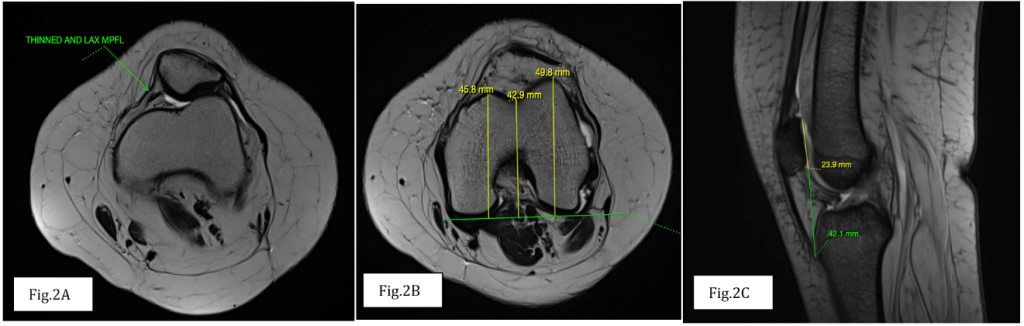 Lax Medial Patellofemoral Ligament Syndrome as a Cause of Recurrent ...