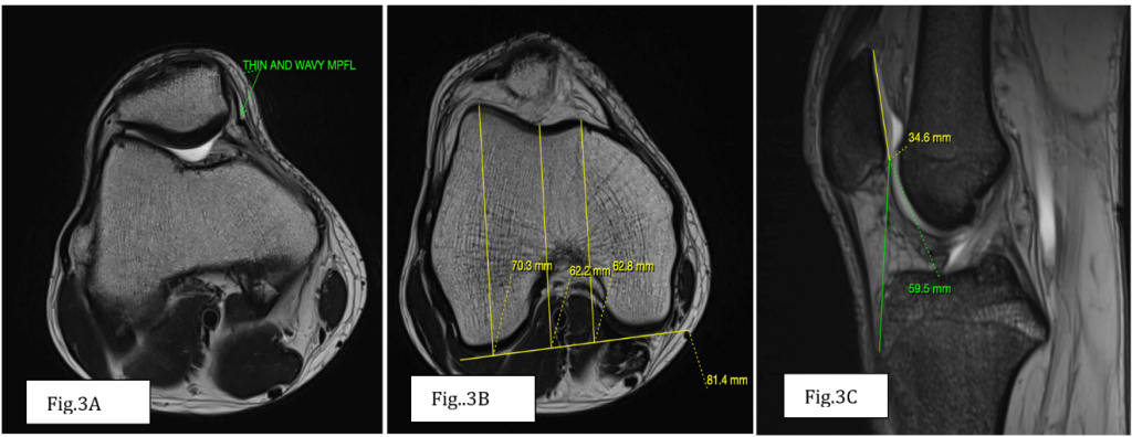 Lax Medial Patellofemoral Ligament Syndrome as a Cause of Recurrent ...