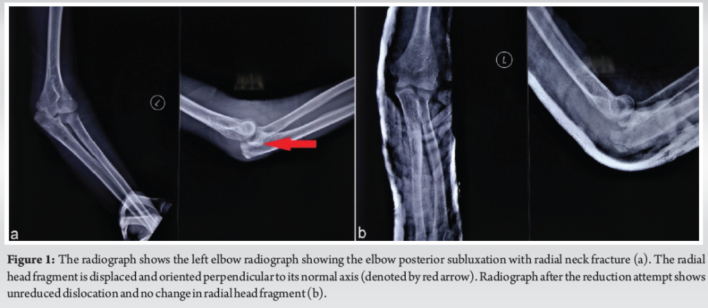 Displaced Jeffery Type 2 Radial Neck Fracture Managed by a Modified ...