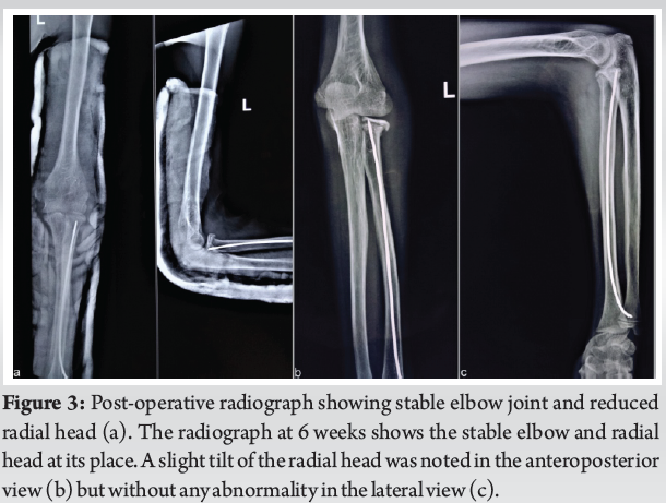 Displaced Jeffery Type 2 Radial Neck Fracture Managed by a Modified ...