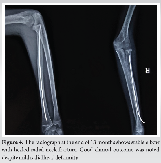 Displaced Jeffery Type 2 Radial Neck Fracture Managed by a Modified ...