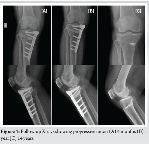 Tibial Nerve injury in Medial Open Wedge-High Tibial Osteotomy – A Rare ...