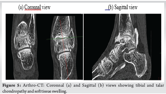 Post-Traumatic Tibio-Fibular Malunion with Hindfoot Valgus: Treatment ...